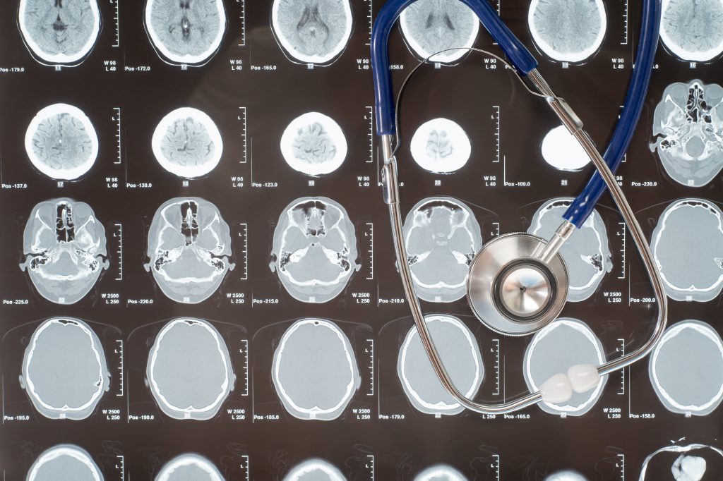 Common Neurological Disorders - Illinois Chiropractic Society