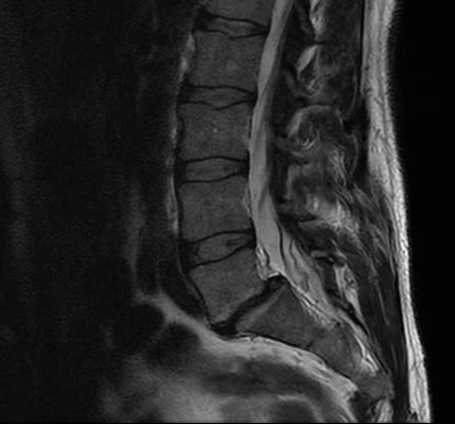 MRI Imaging of Spondylolisthesis - Illinois Chiropractic Society