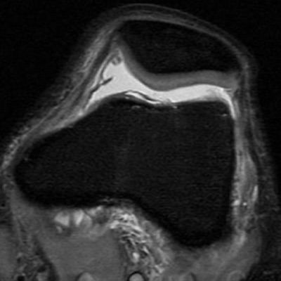 The Imaging of Chondromalacia Patella - Illinois Chiropractic Society