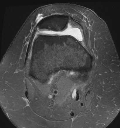 The Imaging of Chondromalacia Patella - Illinois Chiropractic Society