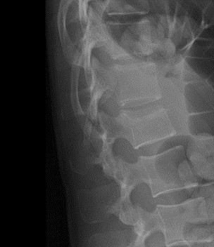 Vertebral Body Compression Fracture, New vs Old - Illinois Chiropractic ...