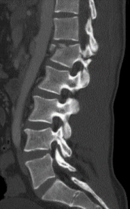 Vertebral Body Compression Fracture, New vs Old - Illinois Chiropractic ...