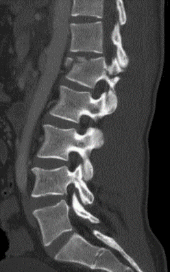 Vertebral Body Compression Fracture, New vs Old - Illinois Chiropractic ...