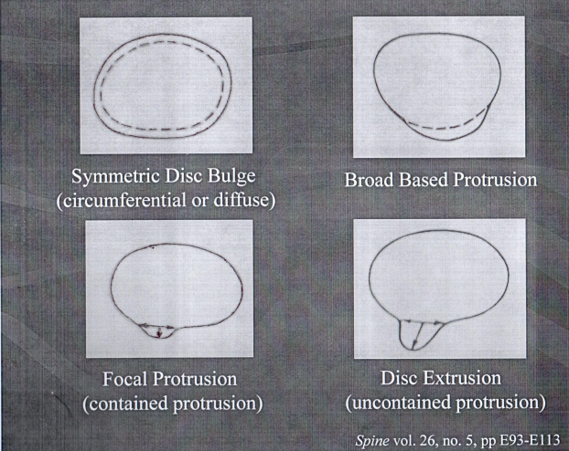 Lumbar Disc Herniation Terminology - Illinois Chiropractic Society