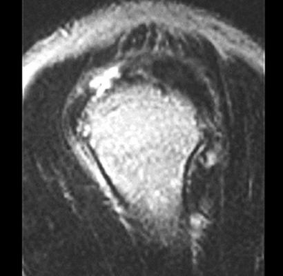 MRI Appearance of Rotator Cuff Tears - Illinois Chiropractic Society