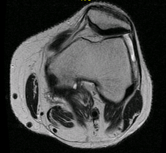 MRI of the Knee Normal Meniscal and Cartilage Anatomy - Illinois ...