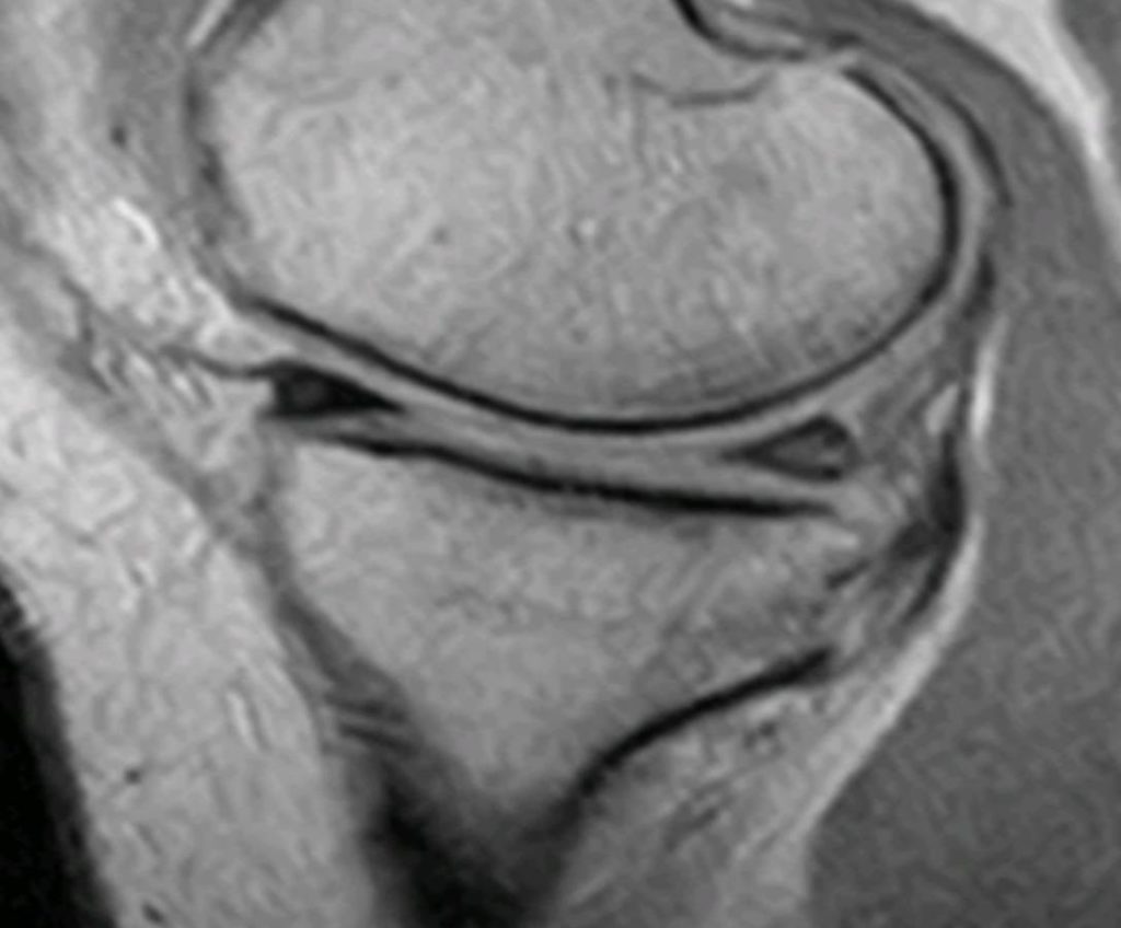 The MRI Appearance of Meniscal Tears - Illinois Chiropractic Society