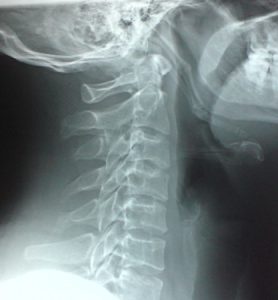 Calcification of the Stylohyoid Ligaments and Thyroid Cartilage ...