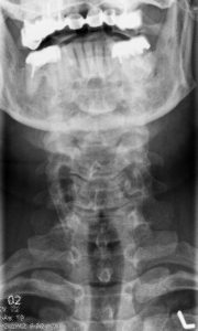 Calcification of the Stylohyoid Ligaments and Thyroid Cartilage ...