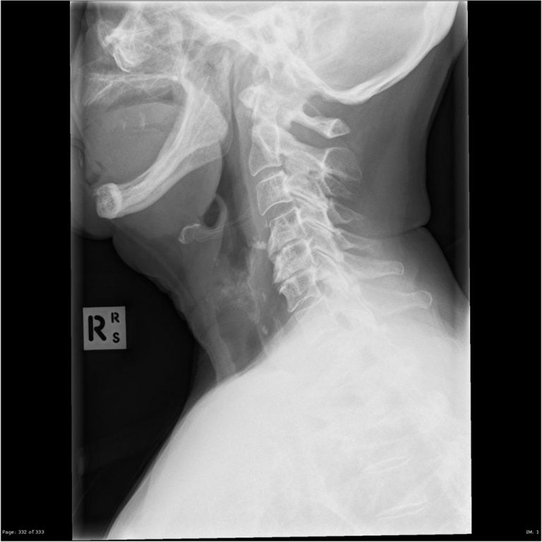 Calcification of the Stylohyoid Ligaments and Thyroid Cartilage ...