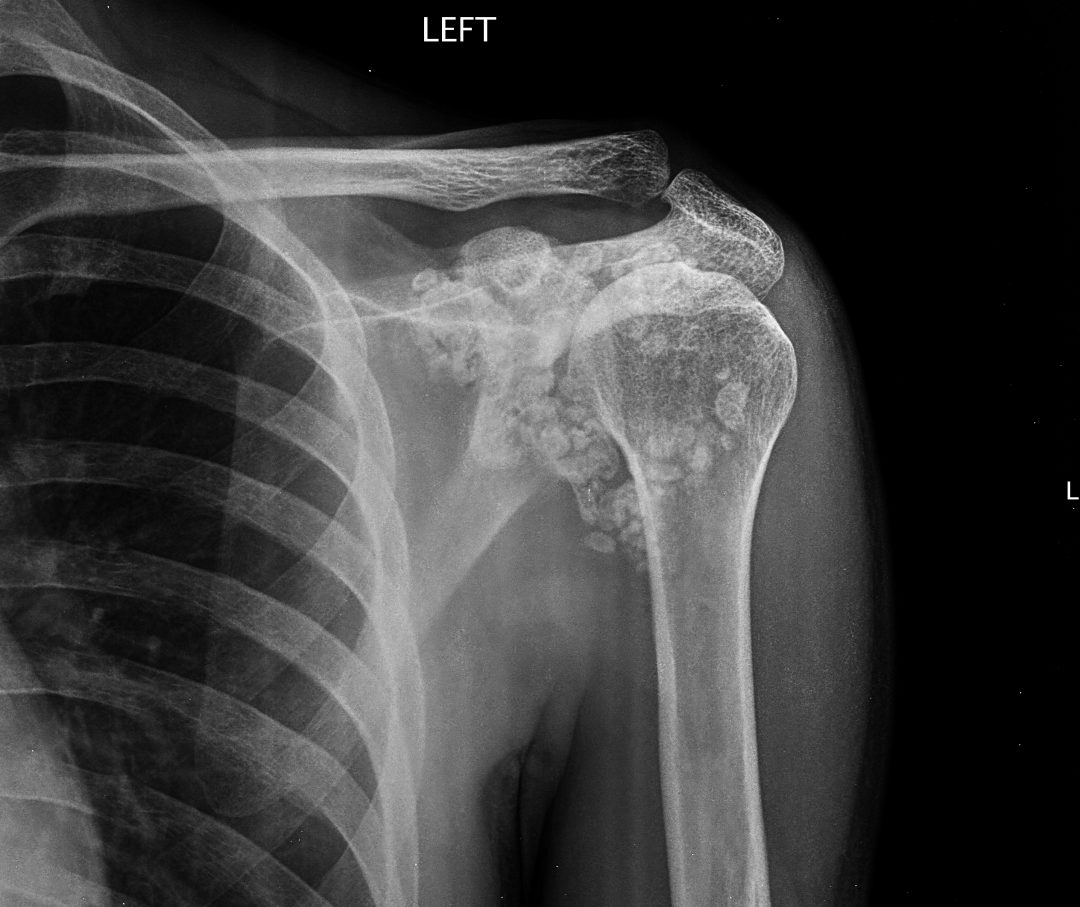 Loose Body Formation Associated with Degenerative Joint Disease and as ...