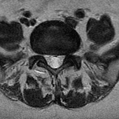 MRI Detection of Paraspinal Muscle Atrophy in Lower Back Pain ...