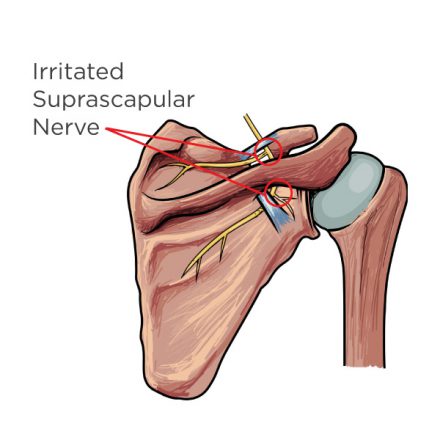 Suprascapular Neuropathy: An overlooked cause of superior shoulder pain ...