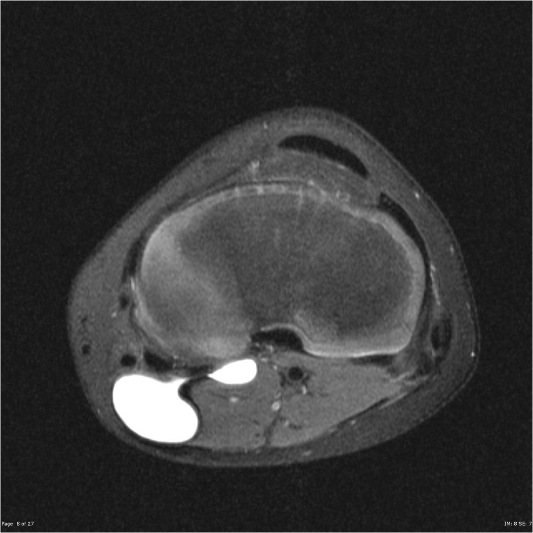 The MRI Appearance and Significance of the Popliteal Cyst - Illinois ...