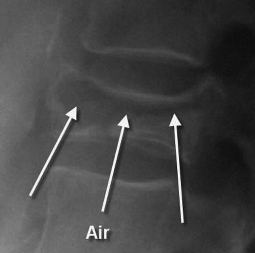 Kummell’s Disease (Delayed Vertebral Body Compression Fracture ...