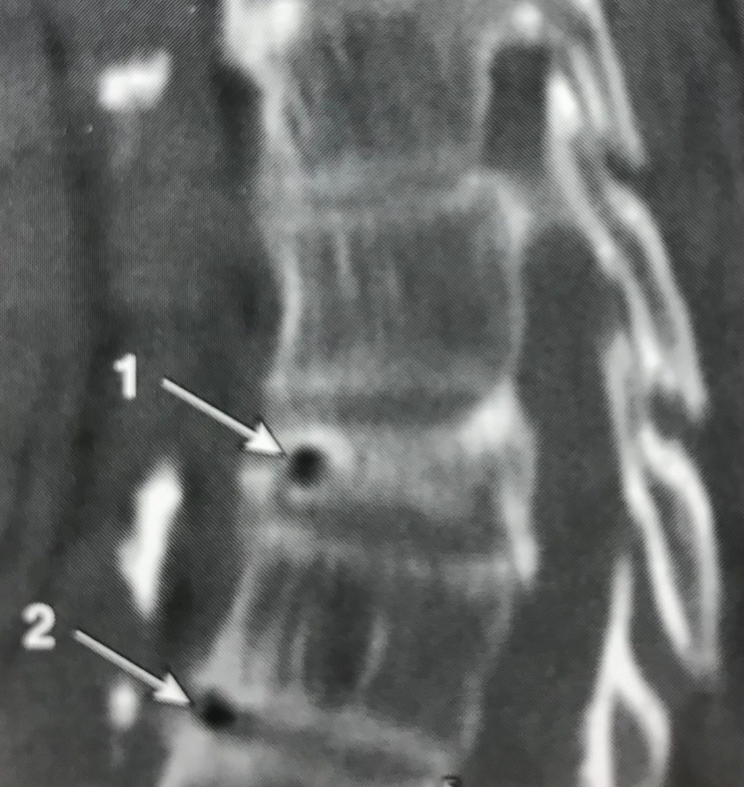Kummell’s Disease (Delayed Vertebral Body Compression Fracture ...