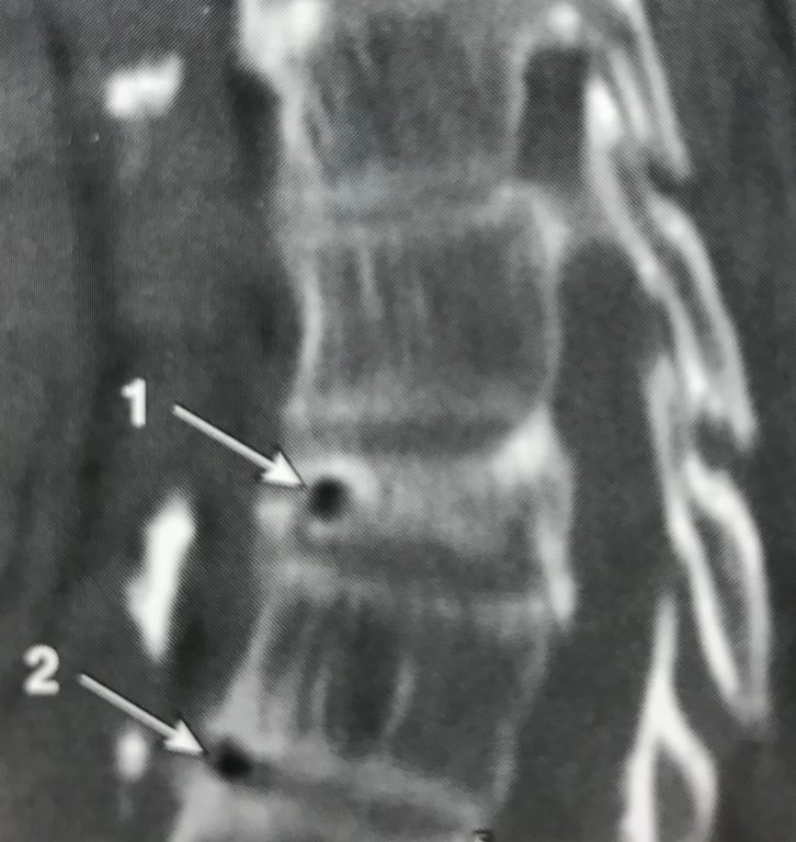 Kummell’s Disease (Delayed Vertebral Body Compression Fracture ...