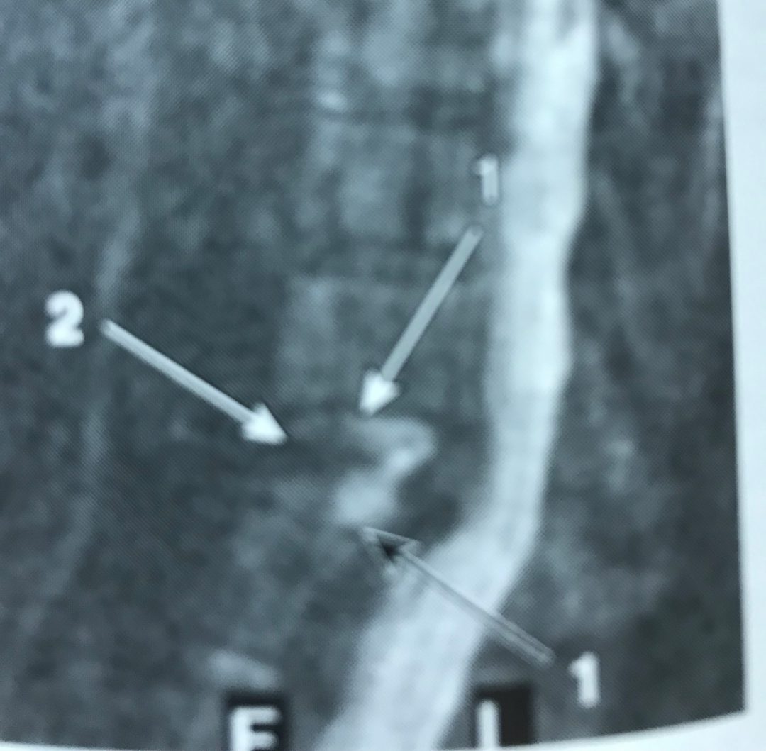 Kummell’s Disease (Delayed Vertebral Body Compression Fracture ...