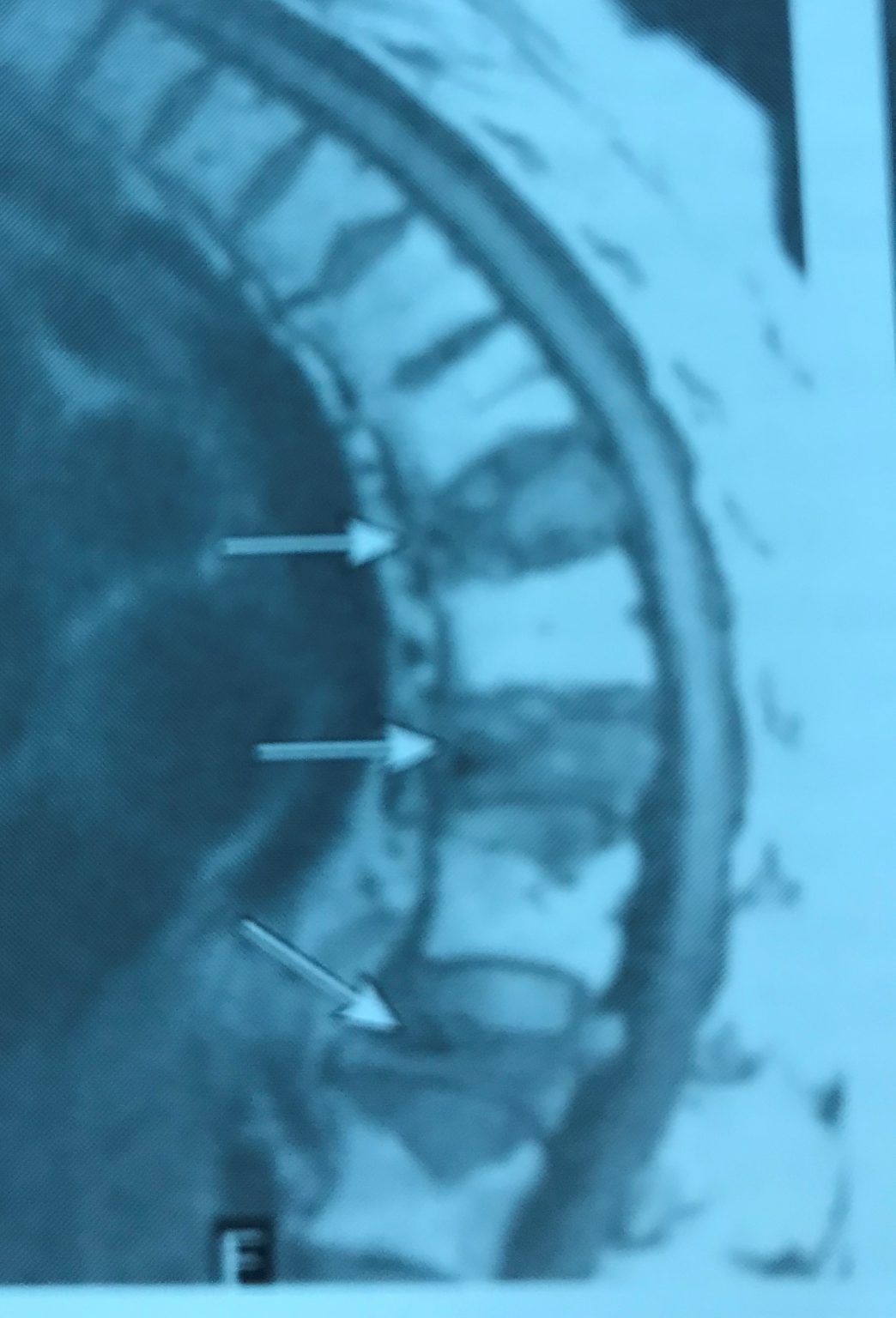 Kummell’s Disease (Delayed Vertebral Body Compression Fracture ...