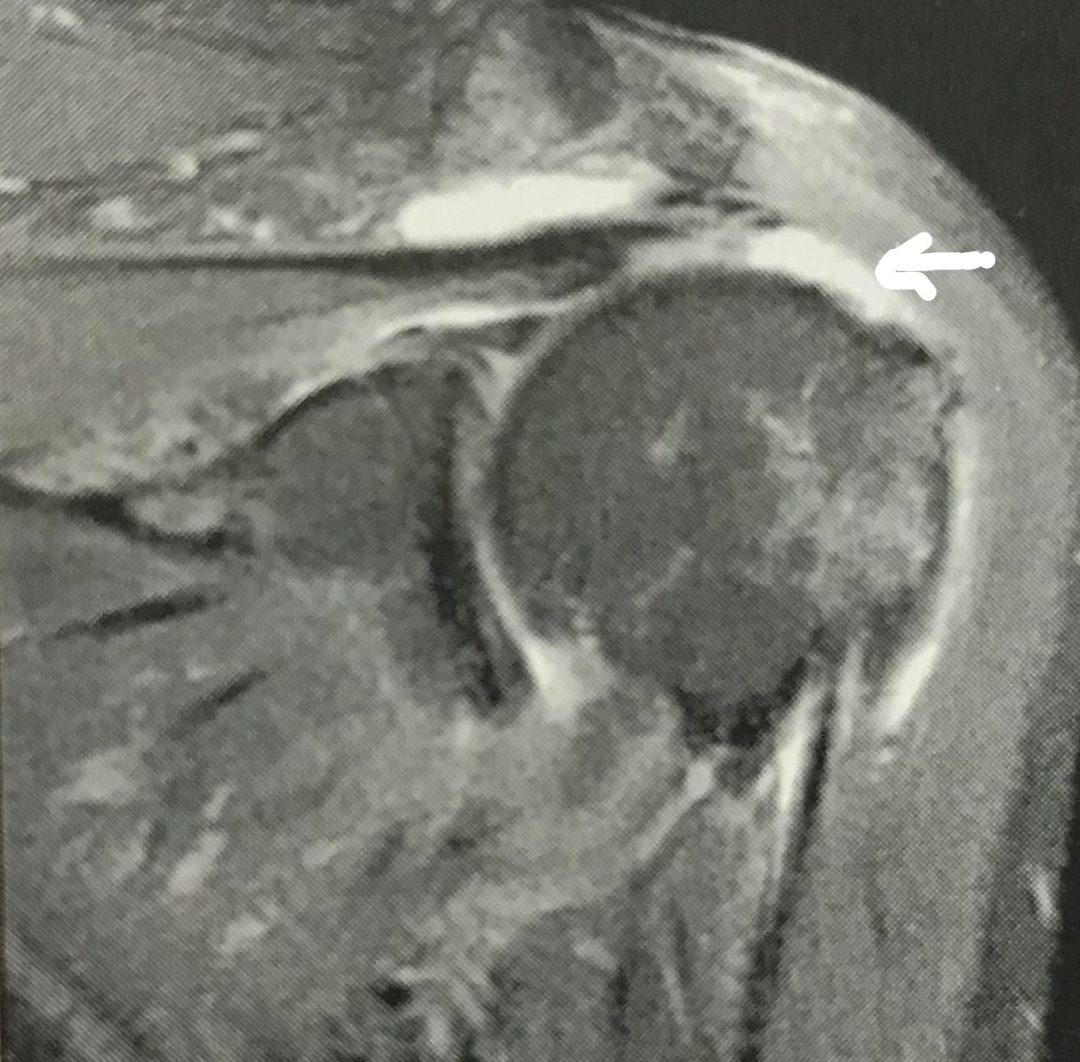 MRI Appearance of Adhesive Capsulitis - Illinois Chiropractic Society