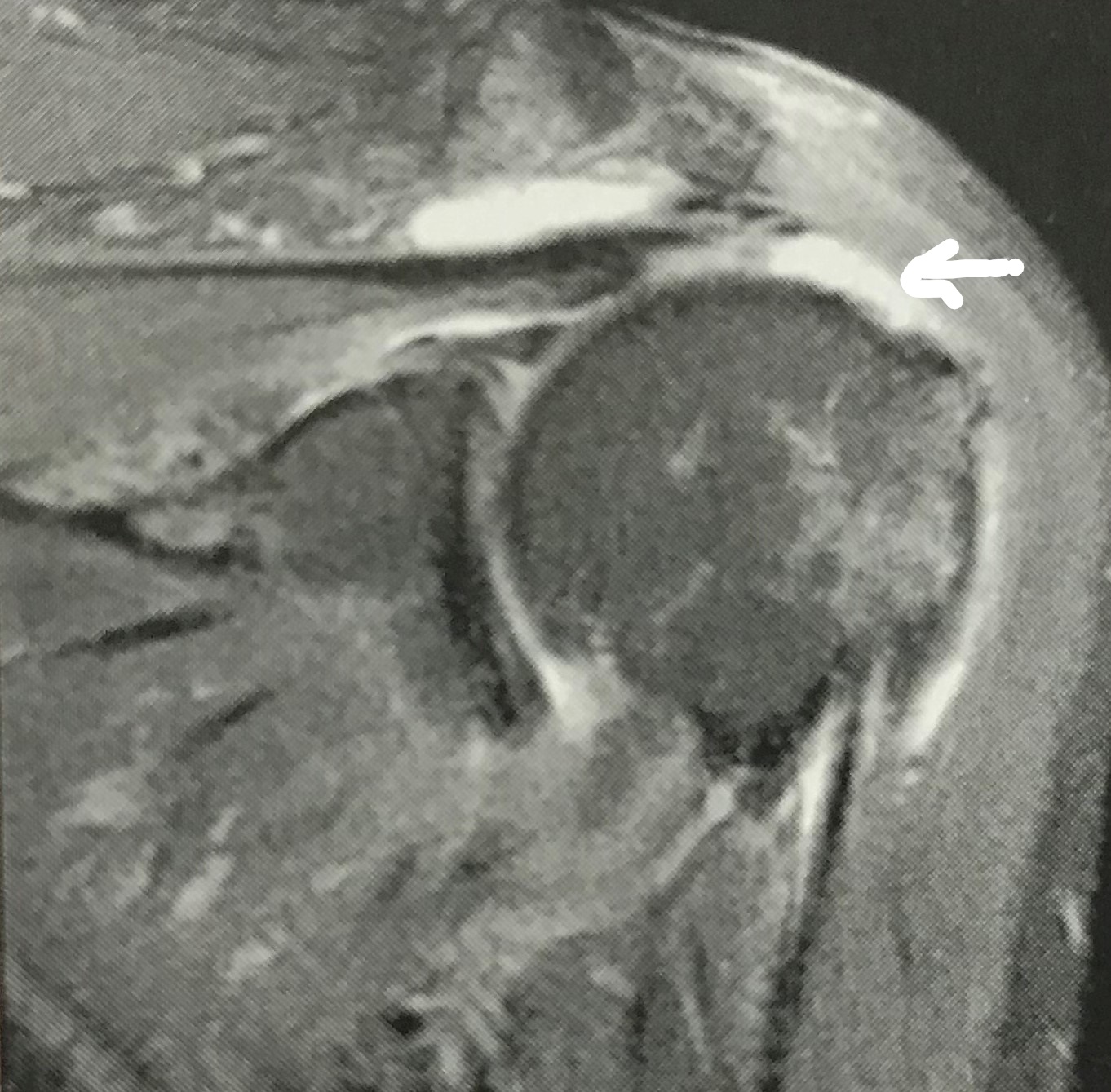 MRI Appearance of Adhesive Capsulitis - Illinois Chiropractic Society