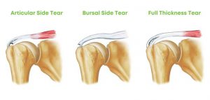 Is It a Full-Thickness or a Partial-Thickness Tear of the Rotator Cuff ...