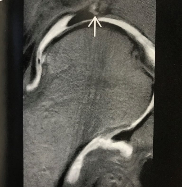 MRI Appearance of Acetabular Labral Tears - Illinois Chiropractic Society