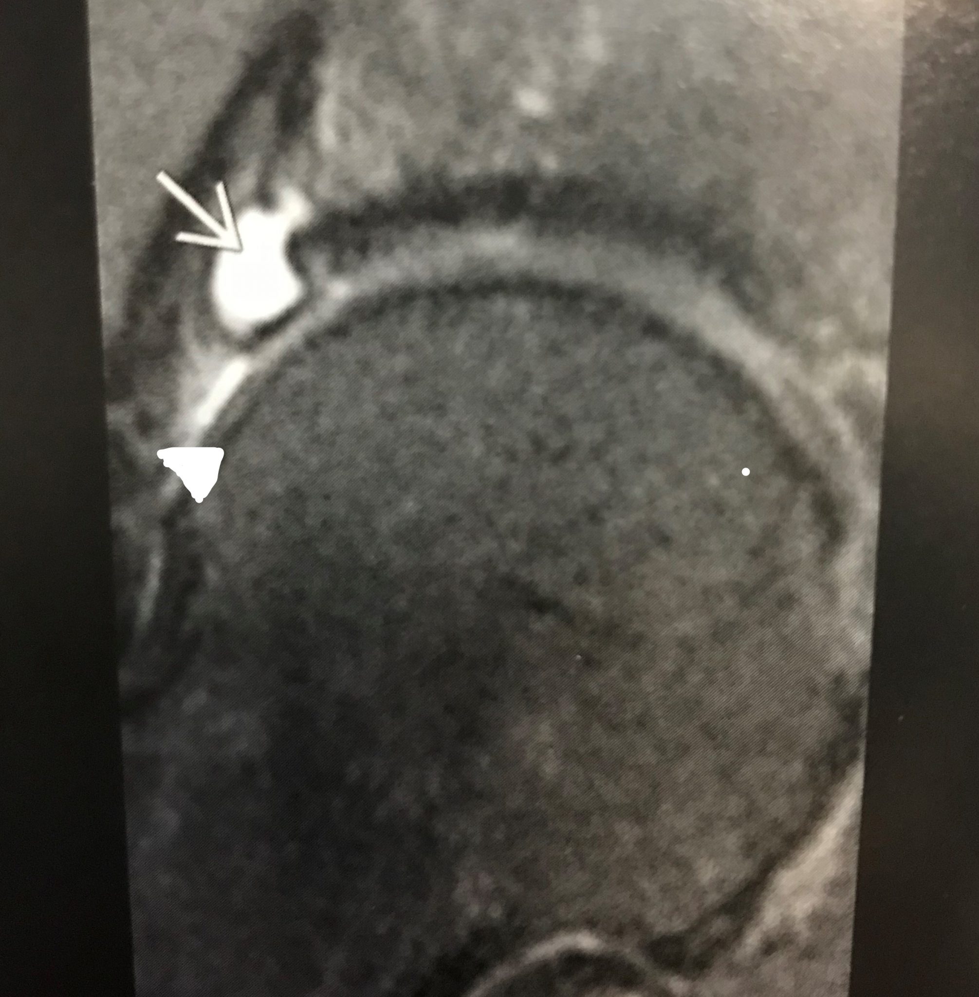MRI Appearance of Acetabular Labral Tears - Illinois Chiropractic Society