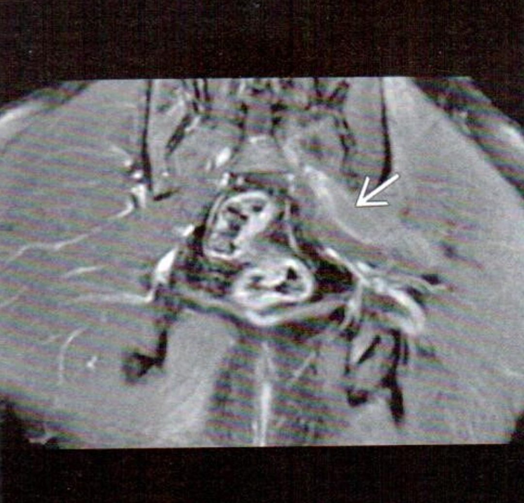MRI Appearance in Piriformis Syndrome - Illinois Chiropractic Society