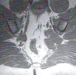 MRI Appearance in Piriformis Syndrome - Illinois Chiropractic Society