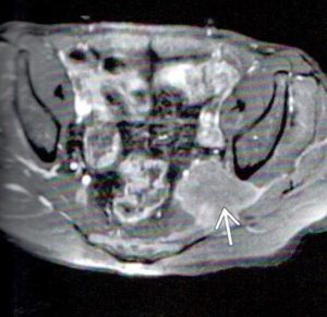 MRI Appearance in Piriformis Syndrome - Illinois Chiropractic Society