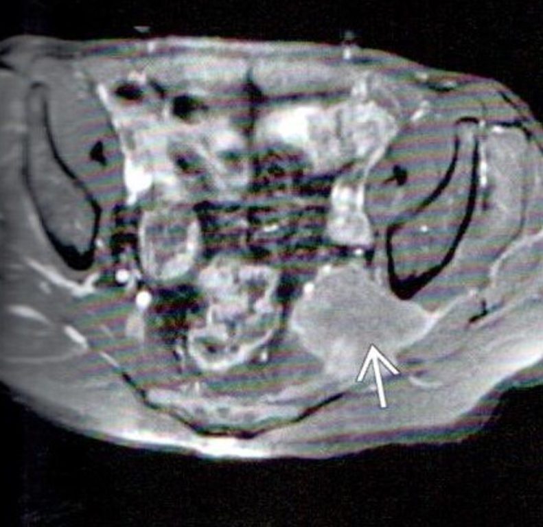 MRI Appearance in Piriformis Syndrome - Illinois Chiropractic Society