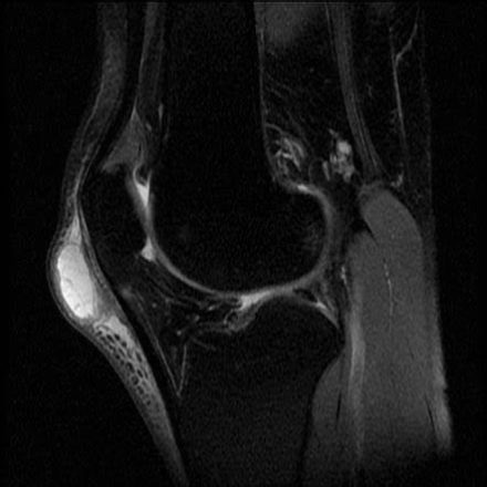 The MRI Appearance of Anterior Patellar Bursitis - Illinois ...