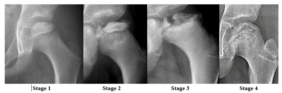 An Uncommon Cause of Hip Pain in an Adult: Healed Legg-Calve-Perthes ...
