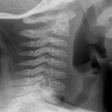Normal Anatomic Variants of the Cervical Spine - Illinois Chiropractic ...
