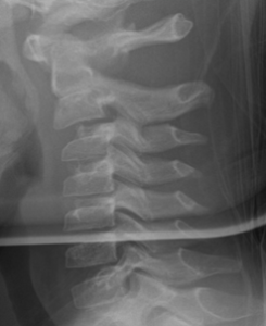 Normal Anatomic Variants of the Cervical Spine - Illinois Chiropractic ...