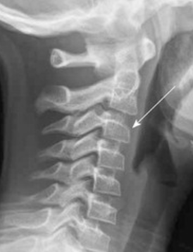 Normal Anatomic Variants of the Cervical Spine - Illinois Chiropractic ...