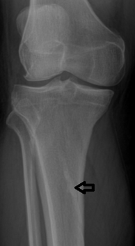Top 5 Masqueraders of Osseous Disease on Radiographs - Illinois ...